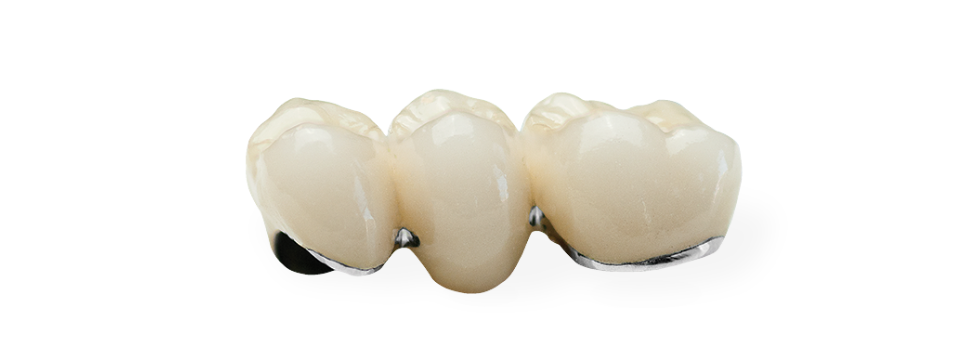 PFMs – R-Dent Dental Laboratory