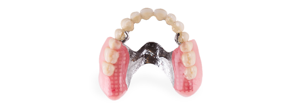 Combo PFM/RPD – R-Dent Dental Laboratory